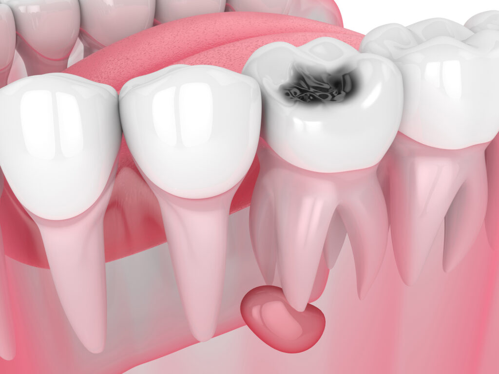 What Does a Cavity Look Like? How to Tell If You Have a Cavity - Grand ...